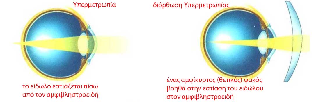 υπερμετρωπία - ΟΦΘΑΛΜόραμα
